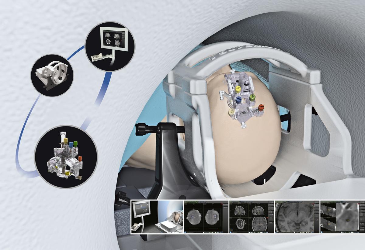 MRI Interventions finding more uses for ClearPoint device - Memphis ...