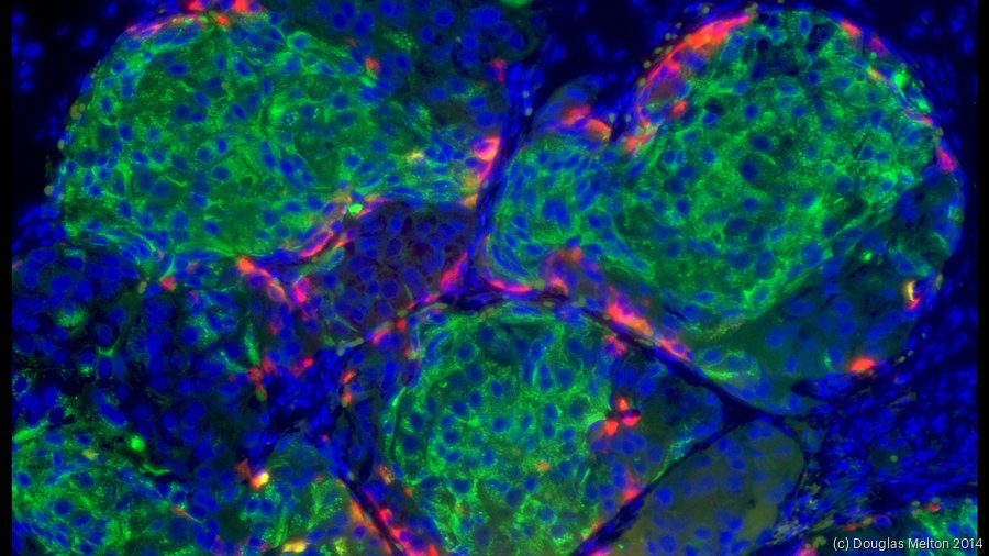 Vertex snaps up Cambridge diabetes startup Semma for $950M - Boston ...