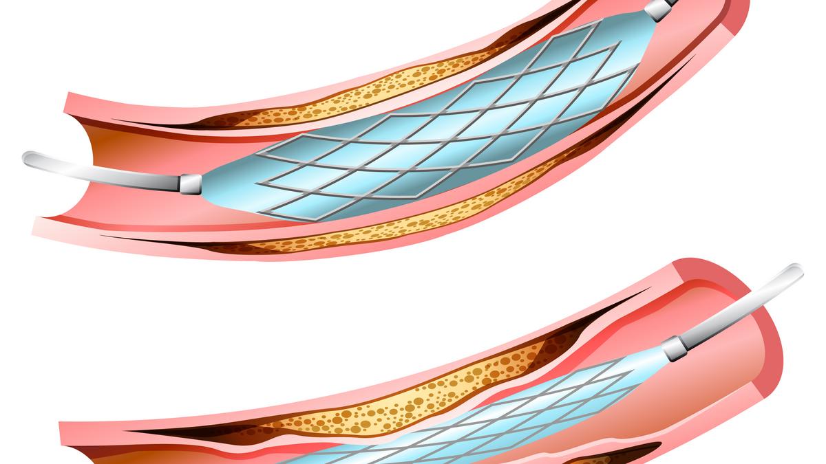 Pitt, UPMC researchers receive $2.5M to develop retrievable stent ...