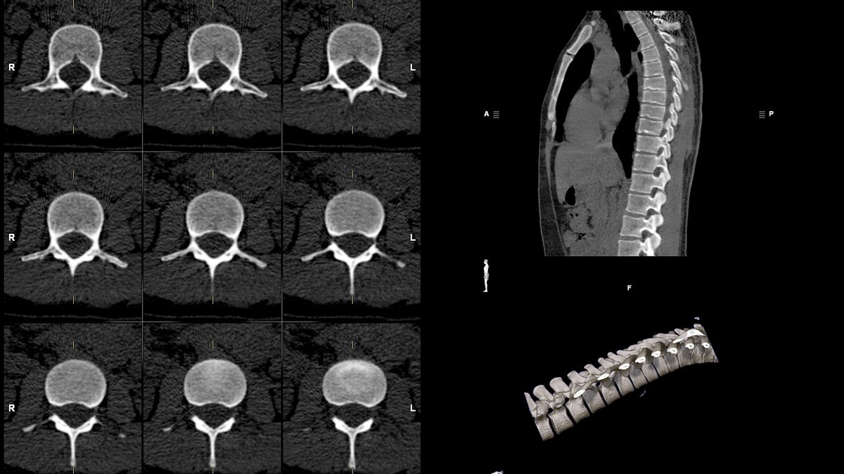 Mercy Health's Jewish Hospital first in Ohio to invest in new Airo ...