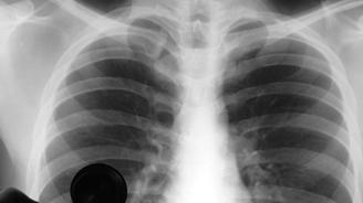 Medical device maker Pulmonx sets targets for $123 million IPO ...