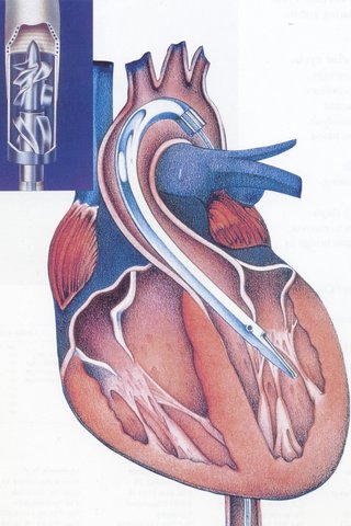 OHSU is racing to be first to market with a permanent total artificial ...