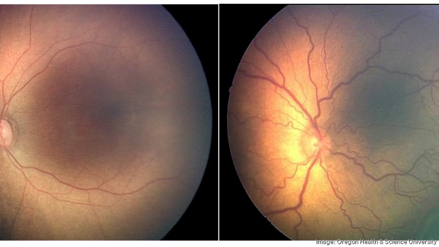 OHSU study finds AI detects blindness in babies better than human ...