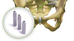 Santa Clara spinal implant startup Si-Bone joins life science IPO ...