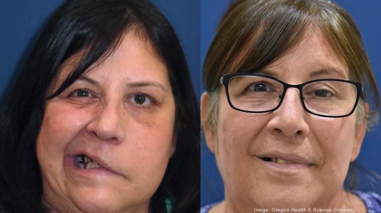 OHSU surgeon reanimates stroke victim's drooping face - Portland ...