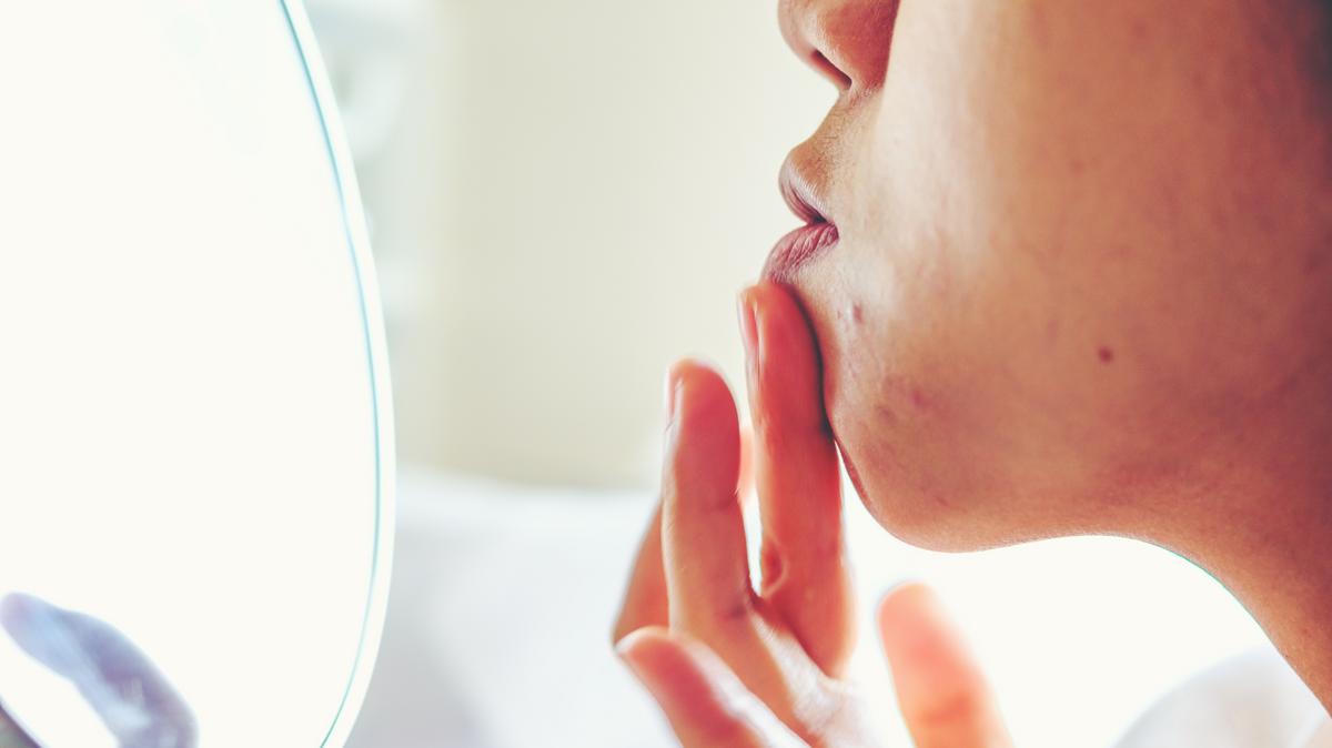 Exton-based Almirall LLC preparing for launch of new acne medicine ...
