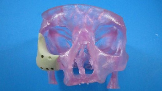 FDA Approves First 3D Printed Face Bones - Washington Business Journal
