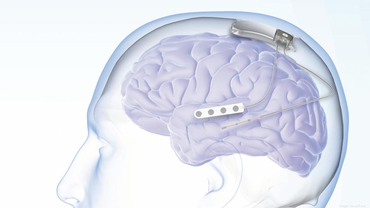Epilepsy device maker NeuroPace files to go public - Silicon Valley ...