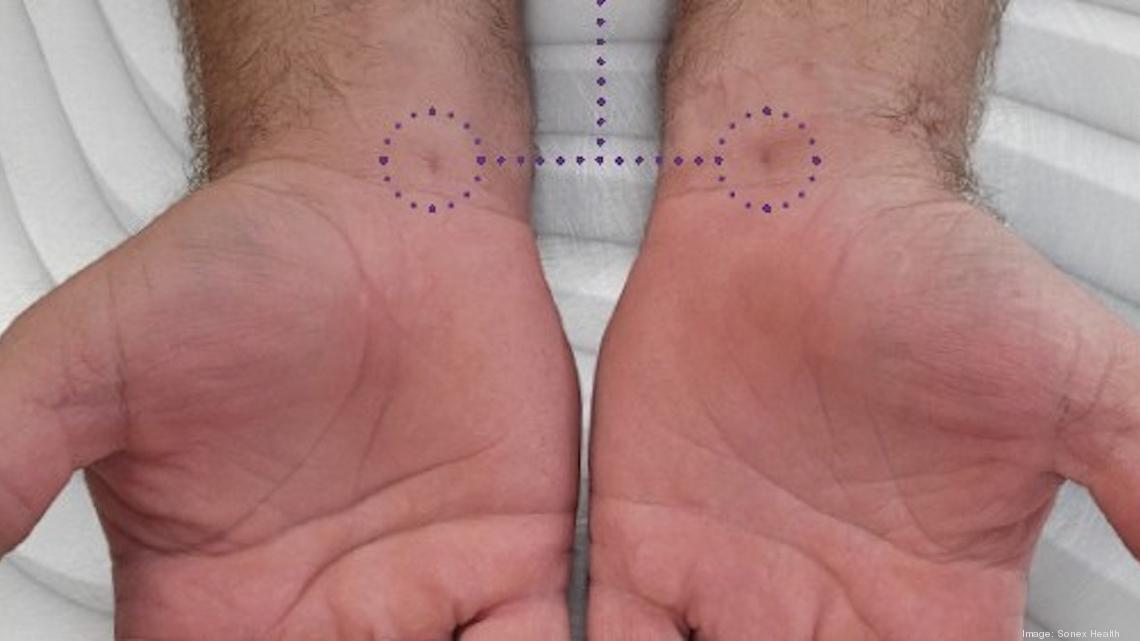 Minne Inno - Sonex Health device for carpal tunnel to be studied in new ...