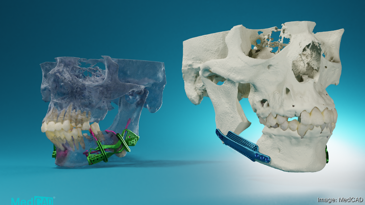 MedCAD unveils 3D-printed surgical devices for facial reconstruction ...