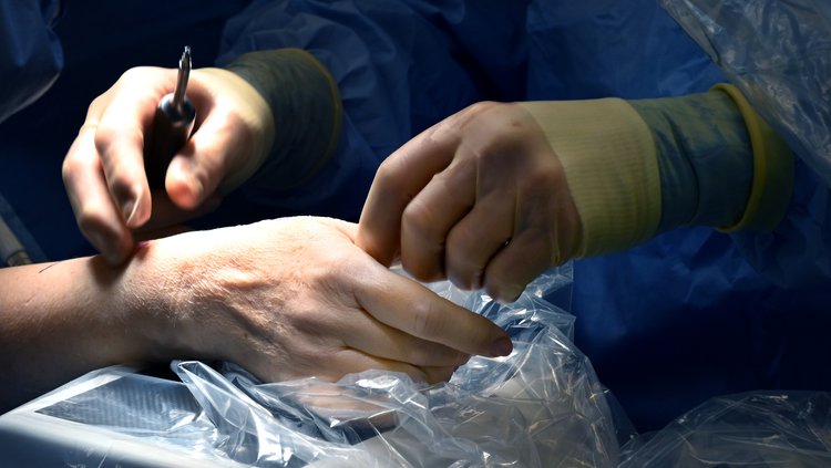 Colorado doctors perform first ‘game-changing’ thumb arthritis surgery ...