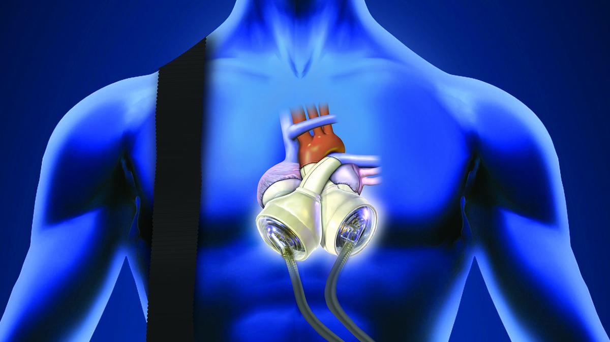 SynCardia Systems to emerge from Chapter 11 reorganization with new ...