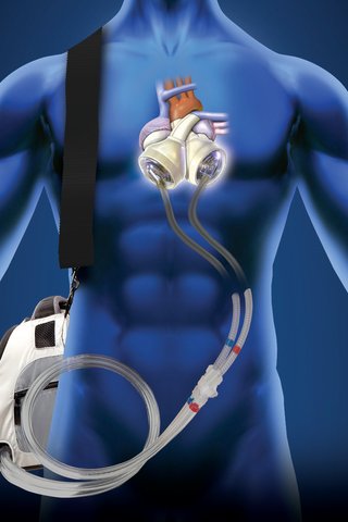 SynCardia Systems to emerge from Chapter 11 reorganization with new ...