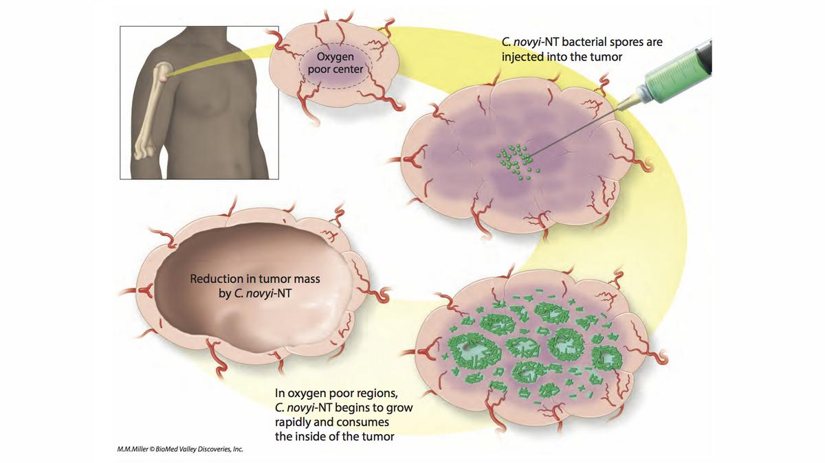 Stowers advances treatment of inoperable tumors - Kansas City Business ...
