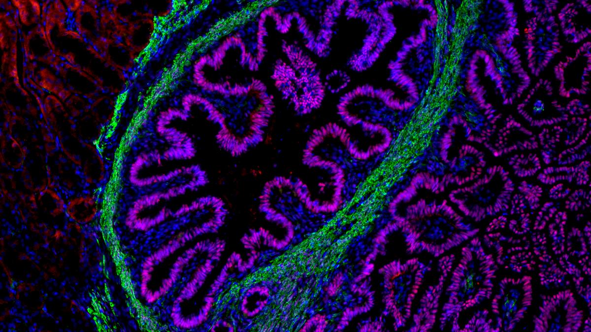 Cincinnati Children's Hospital Medical Center scientists discover how ...