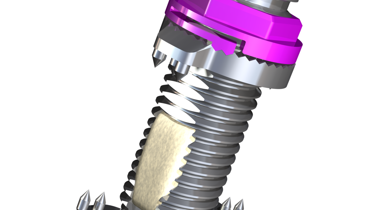 Spinal Simplicity gets new investment backbone from local investor ...