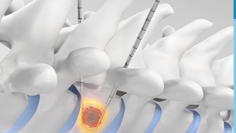 Medtronic buys spine-tumor destroying OsteoCool tech from Baylis ...