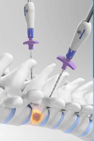 Medtronic buys spine-tumor destroying OsteoCool tech from Baylis ...