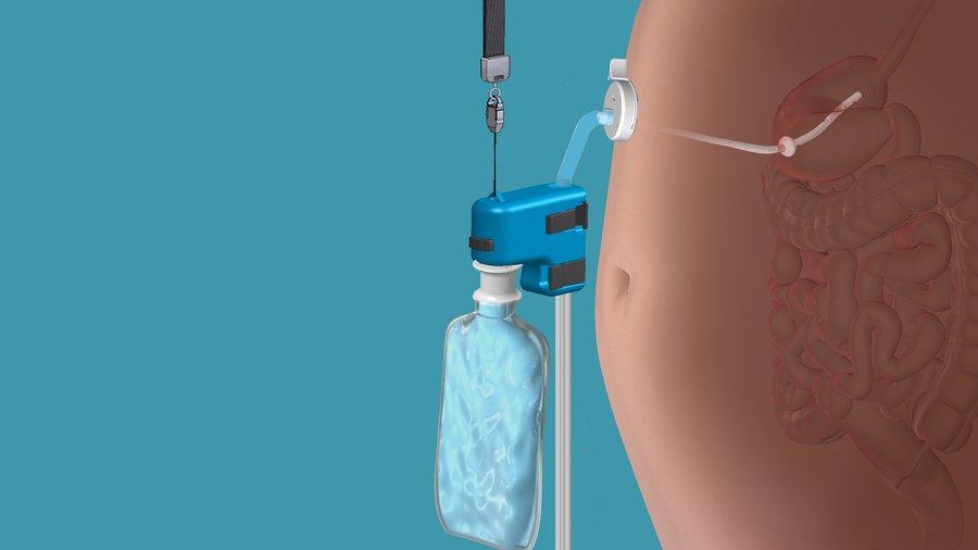 FDA approves Aspire Bariatrics' weight-loss device - Philadelphia ...